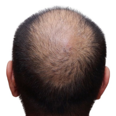 Hair loss treatments for men in Nottingham